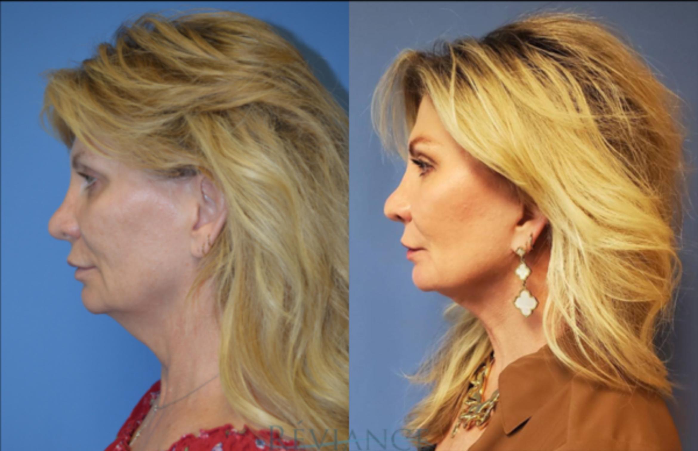 Facelift, necklift, Reviance Facelift