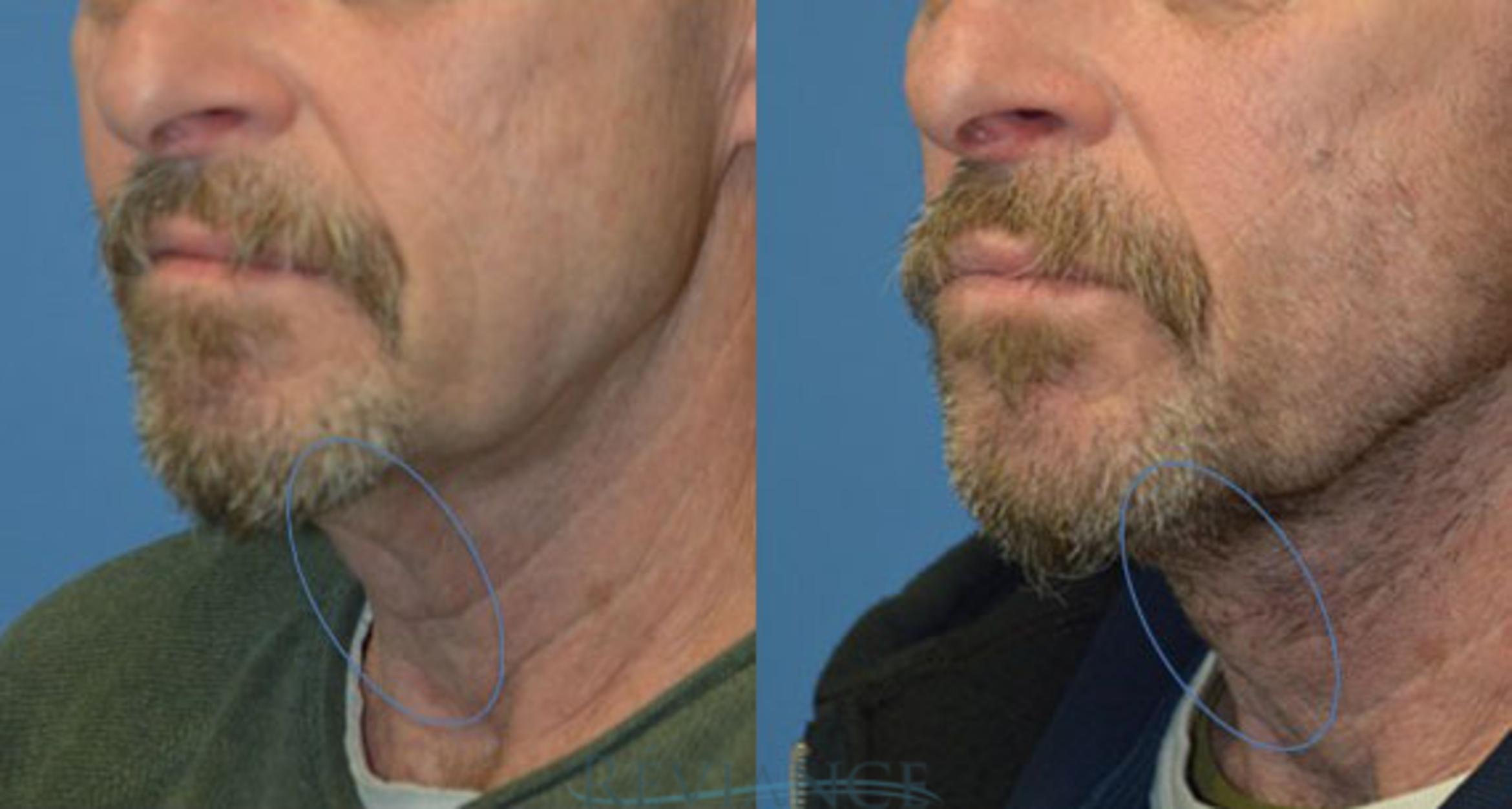 Male deep neck lift, skin tightening, male facelift