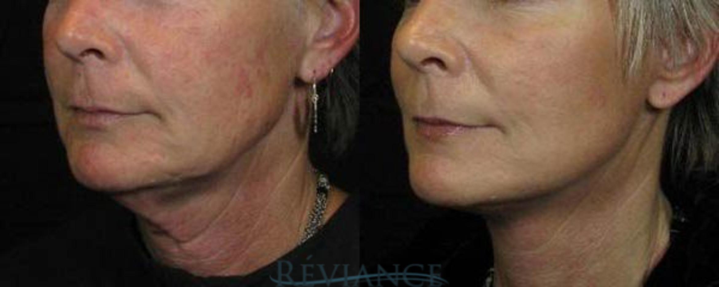 Neck lift, facelift, improve neck and jowls