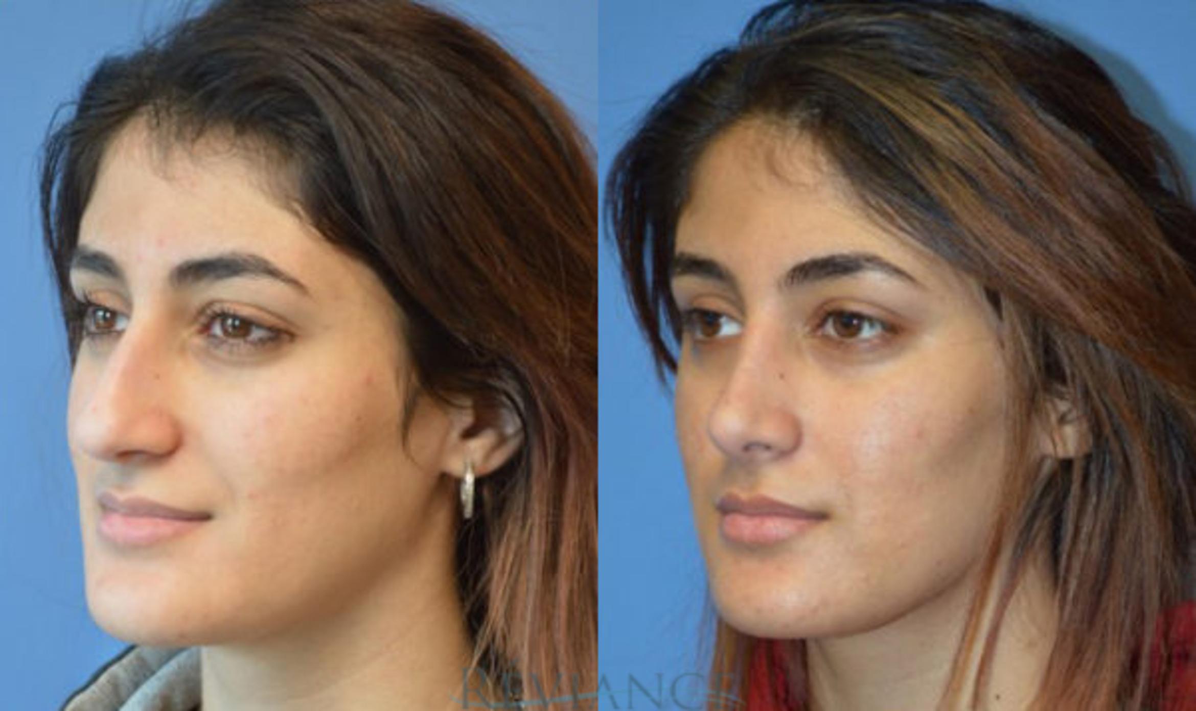 Rhinoplasty, open approach rhinoplasty, dorsal hump reduction