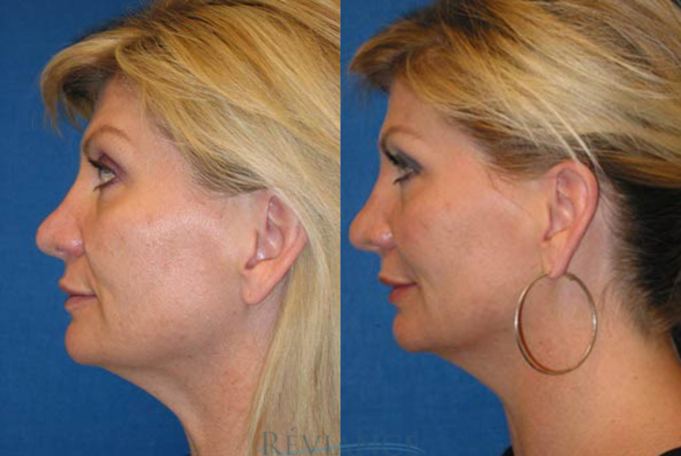 non-surgical neck lift, non-surgical facelift, neck tightening
